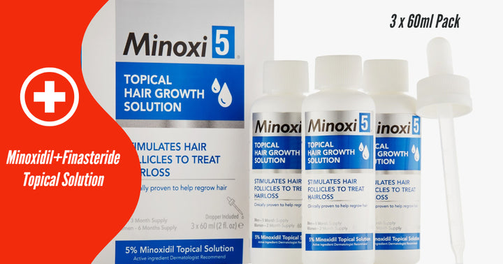 Hair loss treatment with Minoxi5 – Shop Minoxidil